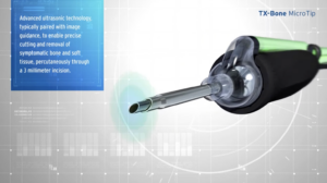 Patient-Tenex - Trice Medical