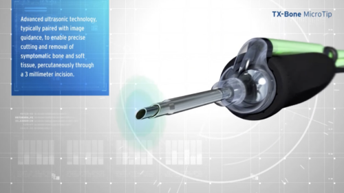 Patient-Tenex - Trice Medical