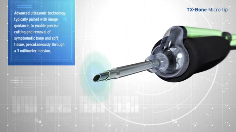 Patient-Tenex - Trice Medical