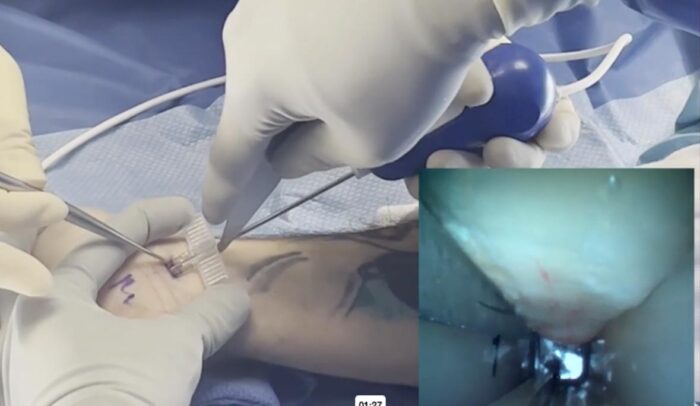 mi-eye 15 angled - Trice Medical